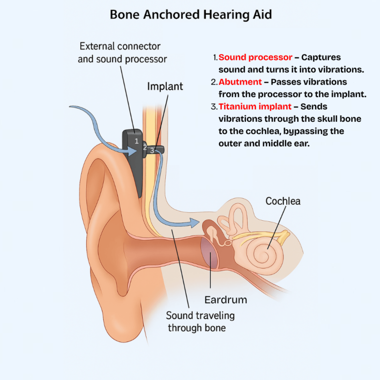 Bone Anchored Hearing Aids (BAHA) - Indorewala ENT Hospital